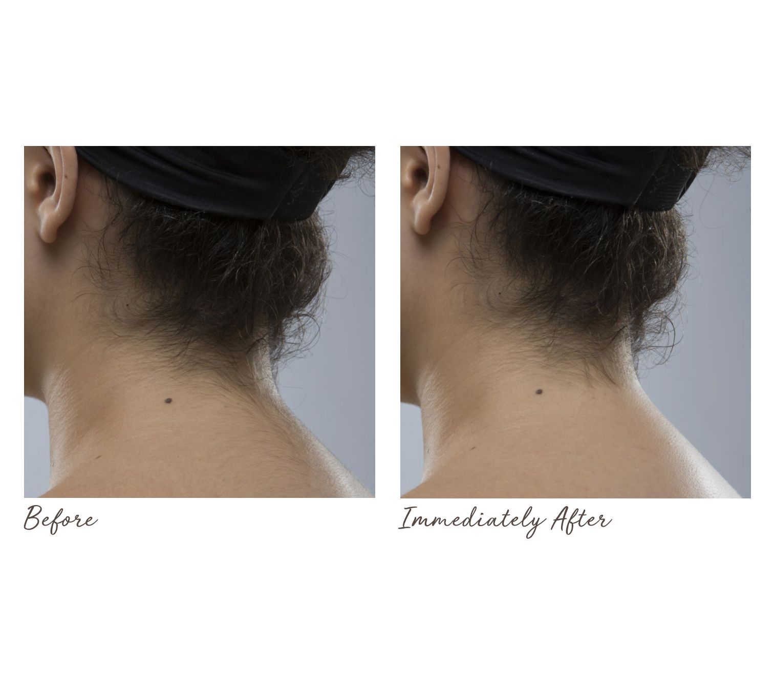 (QVC) Conture Set of 2 Hair Remover and Exfoliation Device ...