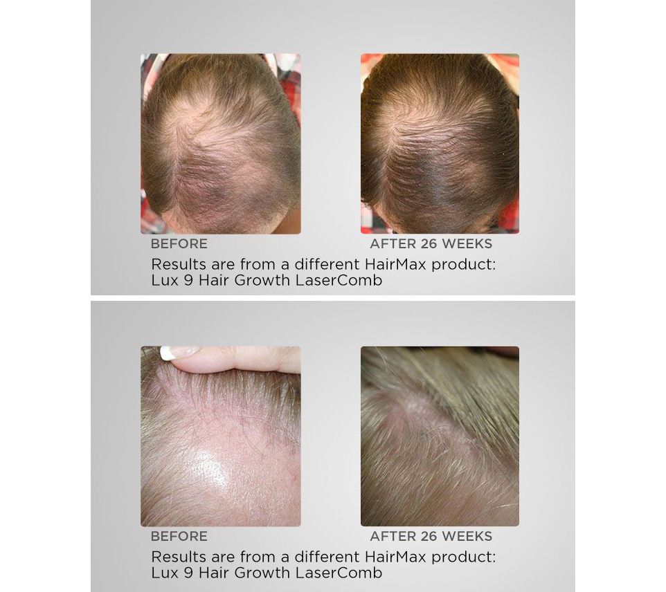 (QVC) Q2 – HairMax LaserBand 41 StretchFit Hair Growth Laser Device ...