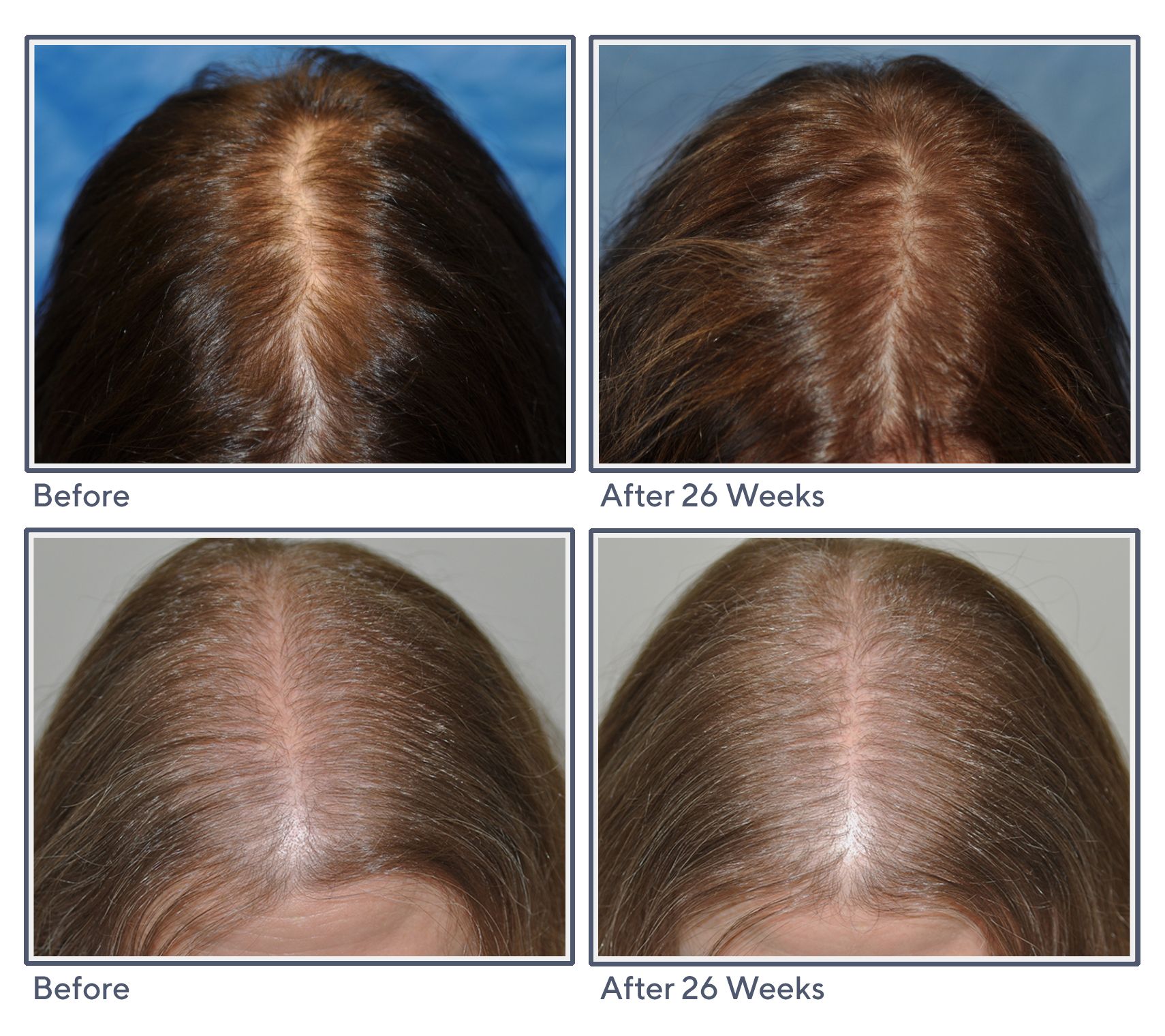 Hairmax Actonis 18 Dual Action LaserComb - QVC.com