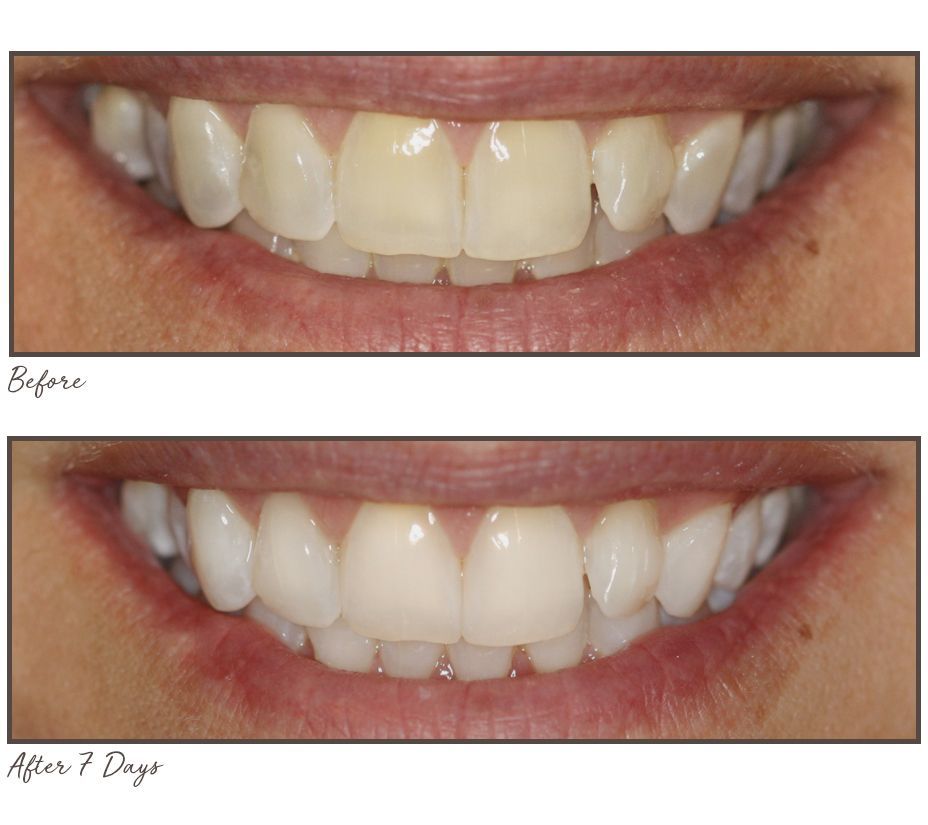 Smileactives Set of 4 Holiday Teeth Whitening Pens - QVC.com