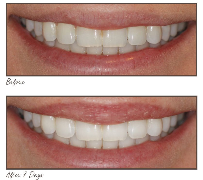 Smileactives Set of 4 Holiday Teeth Whitening Pens - QVC.com