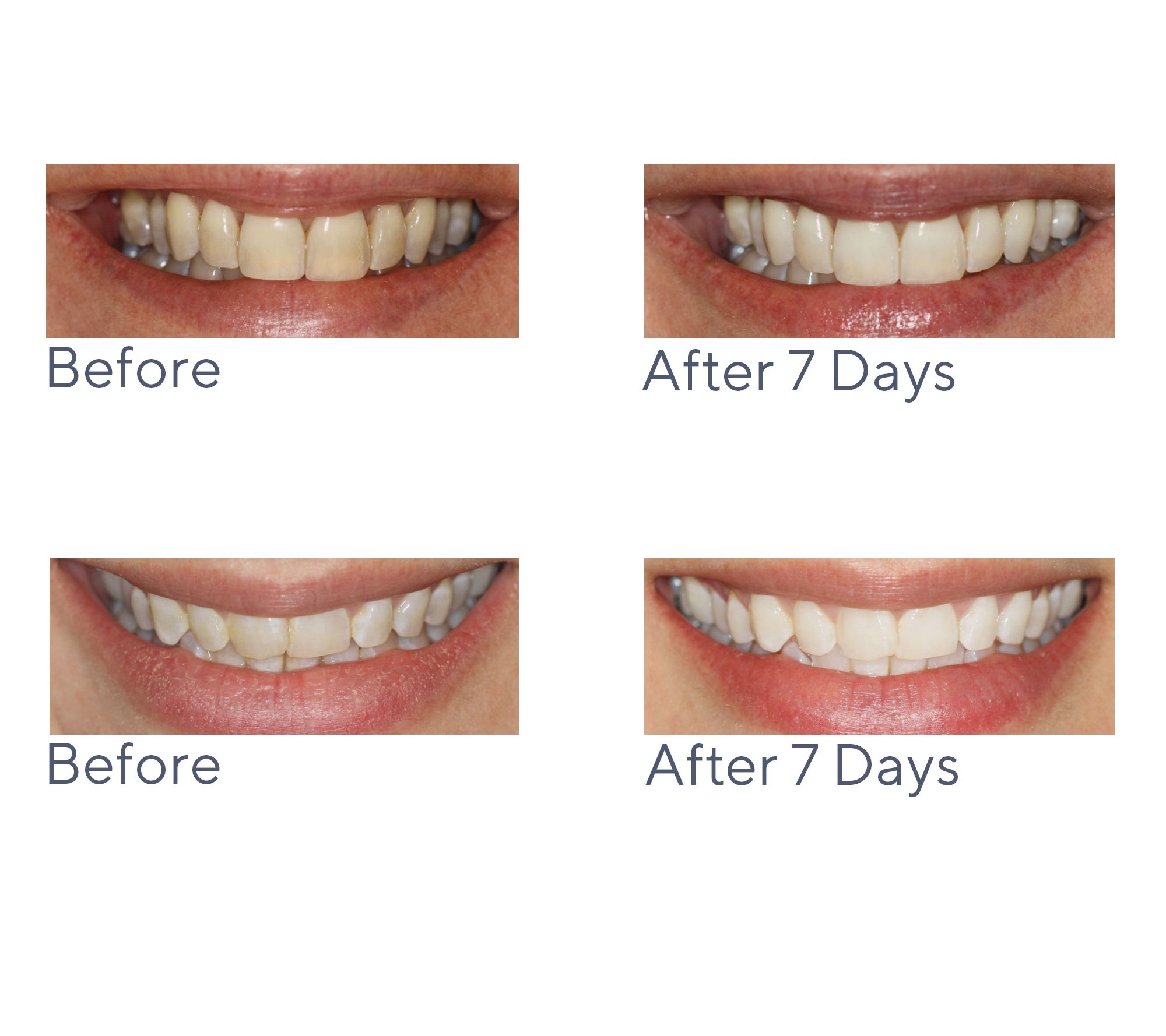 Smileactives Leah's Favorites Set of 3 Teeth Whitening Pens - QVC.com