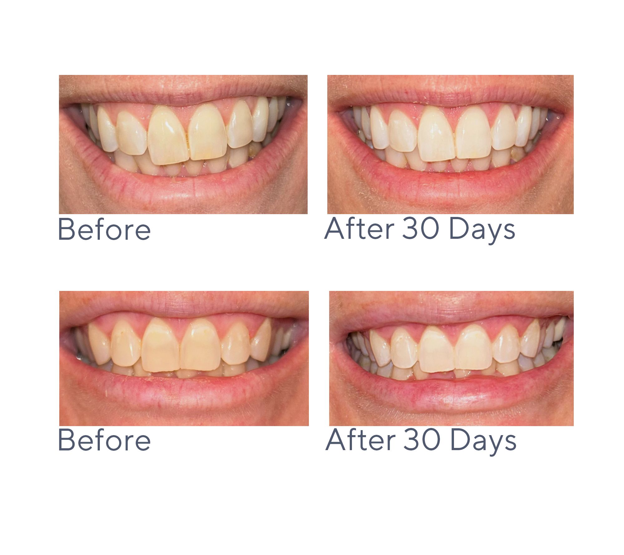 Smileactives Super-Size Pro Teeth Whitening 7.6oz Gel - QVC.com