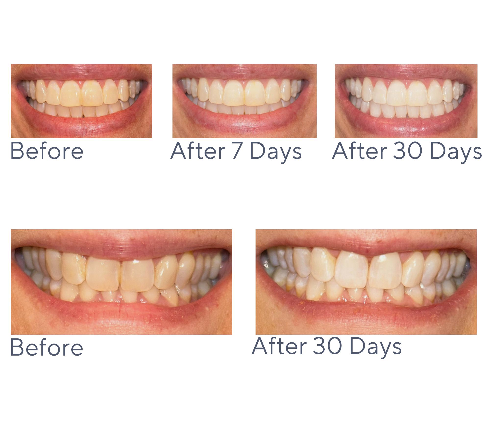 Smileactives Super-Size Pro Teeth Whitening 7.6oz Gel - QVC.com