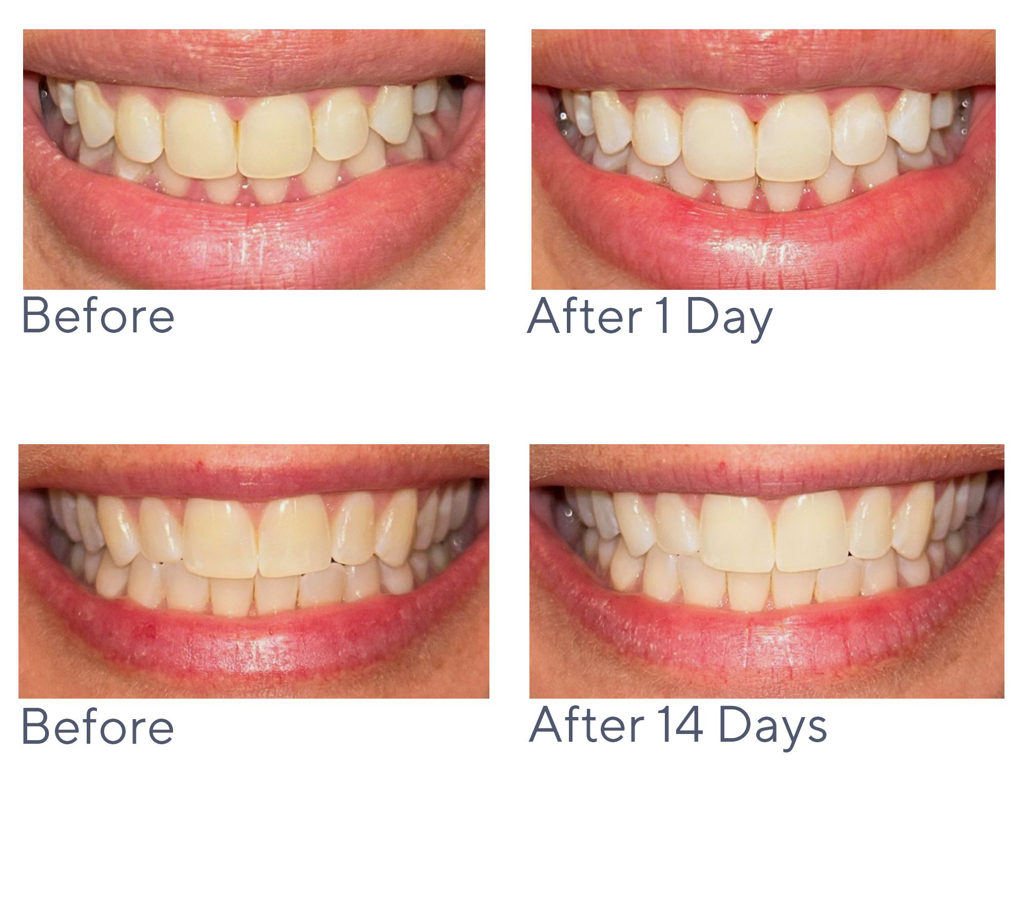 Smileactives Super-Size Pro Teeth Whitening 7.6oz Gel - QVC.com