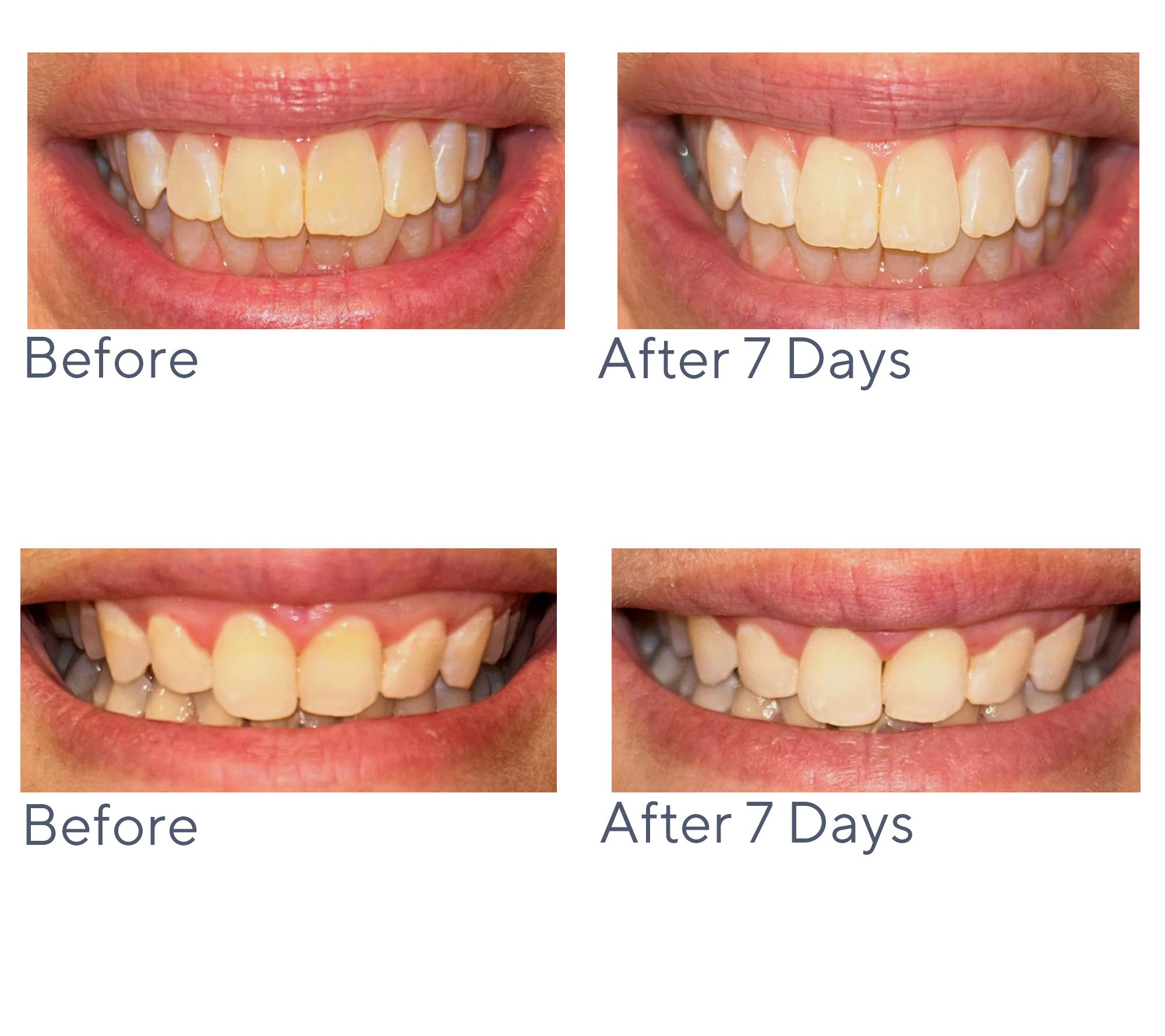 Smileactives Super-Size Pro Teeth Whitening 7.6oz Gel - QVC.com