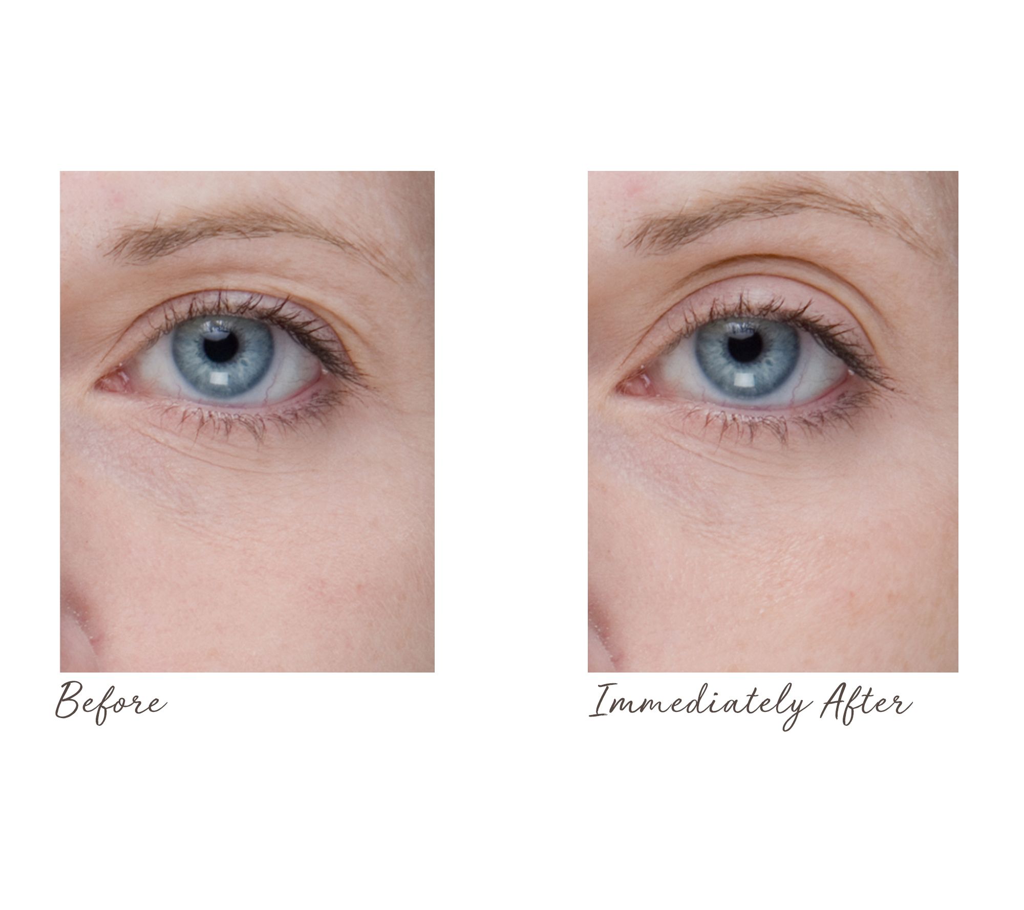 (QVC) NuFACE Mini Face & Neck Toning Device with 6-Month Supply of Gels ...